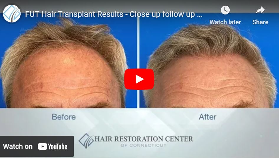 1900 Hair Grafts To Restore Hairline Video Case Study - Hair ...