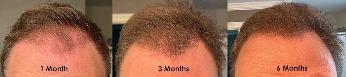 6 Month Hair Transplant Transition - Hair Restoration Center of CT ...