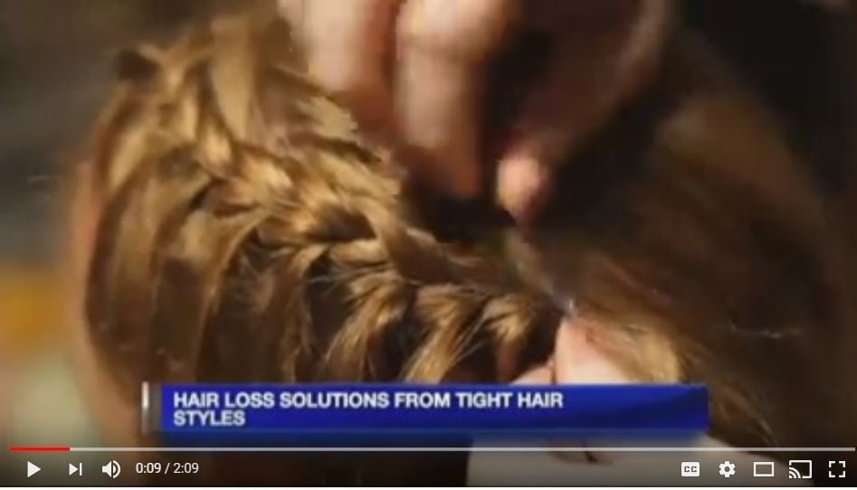Hair Loss on The Edges - - Traction Alopecia Hair Restoration Center of CT