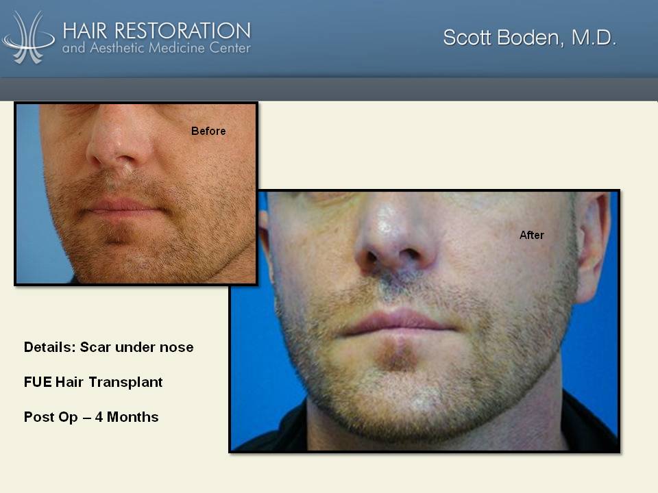 FUE hair transplant from beard covers facial scar in mustache area ...