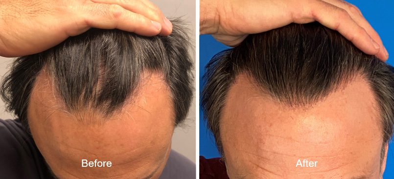 2600 Hair grafts to Restore Hairline and Frontal Zone - Hair ...