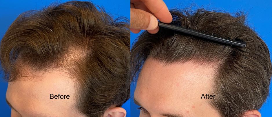 Hairline Restoration with FUT Donor Strip Harvest - Hair Restoration ...